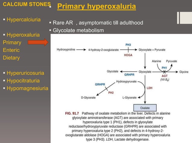 Urolithiasis pathophysiology , medical management | PPTX
