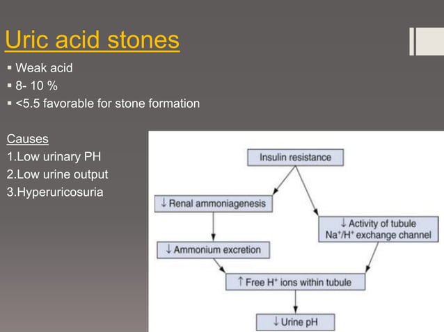 Urolithiasis pathophysiology , medical management | PPTX