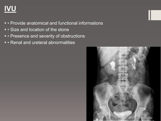 Urolithiasis pathophysiology , medical management | PPT