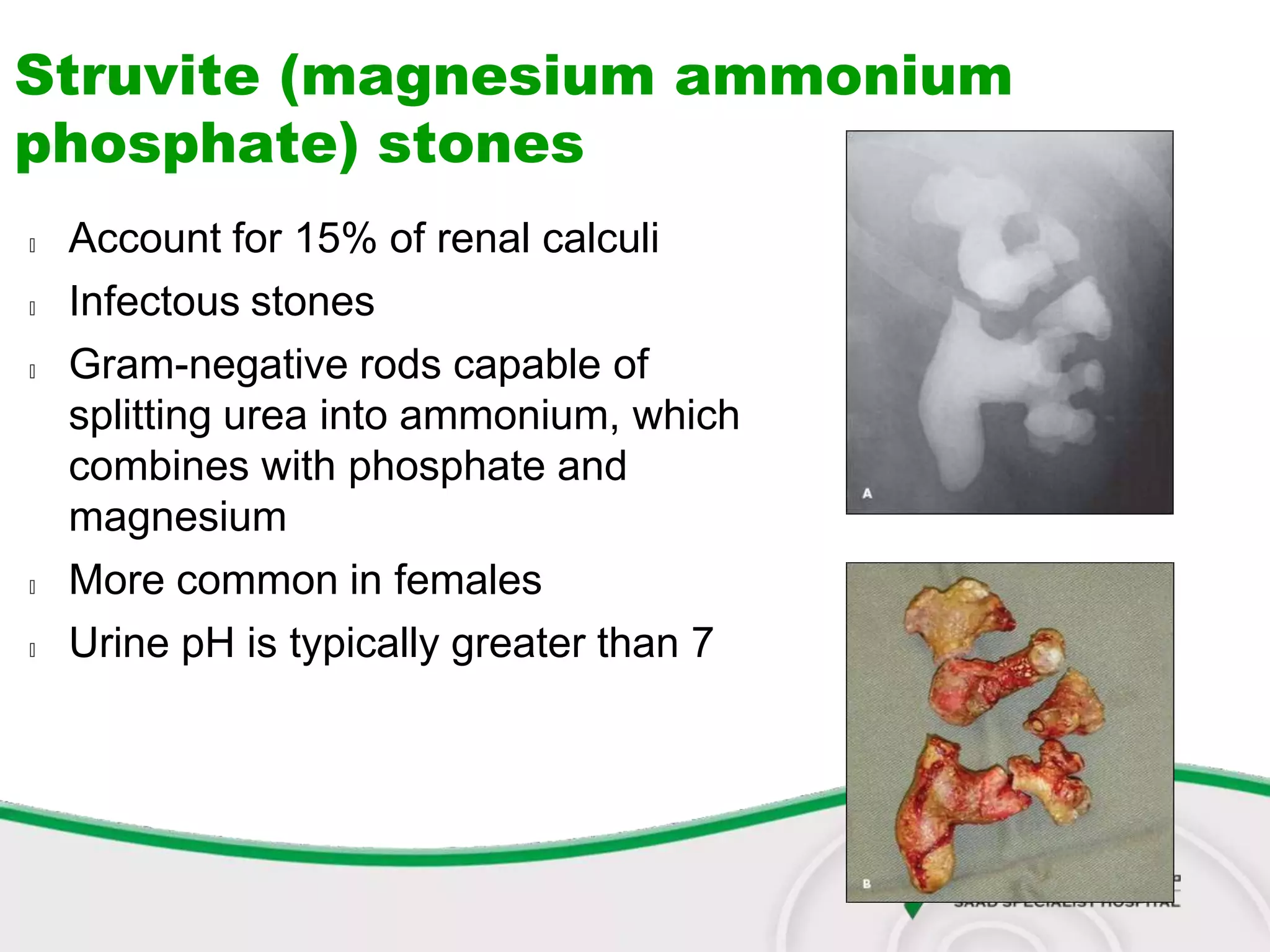 urolithiasisurinarystonesdiseasepresentation-140517114444-phpapp01.pptx