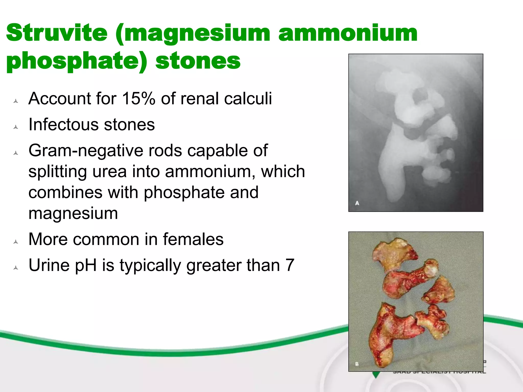 Urolithiasis (urinary stones disease) presentation | PPTX