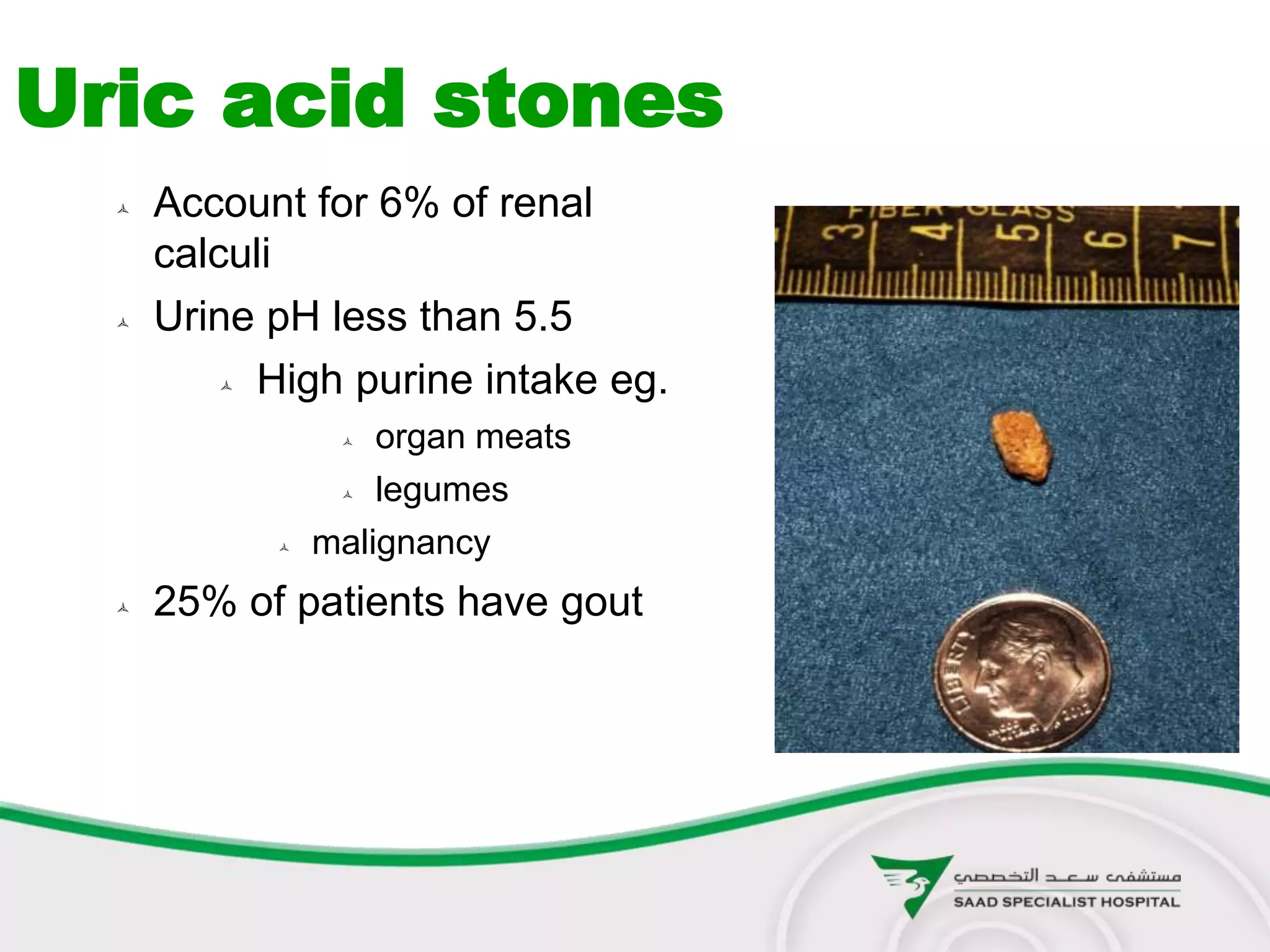 Urolithiasis (urinary stones disease) presentation | PPTX
