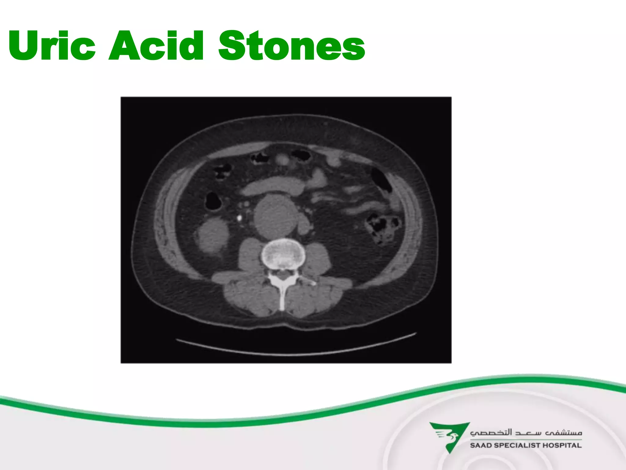 Urolithiasis (urinary stones disease) presentation | PPTX