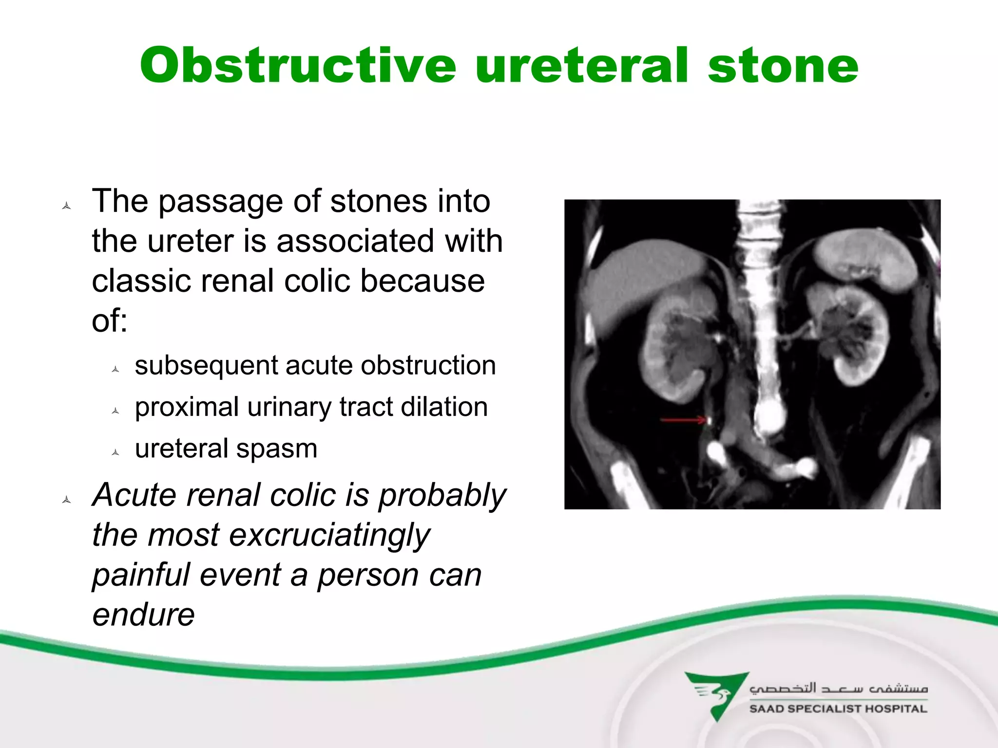 Urolithiasis (urinary stones disease) presentation | PPTX