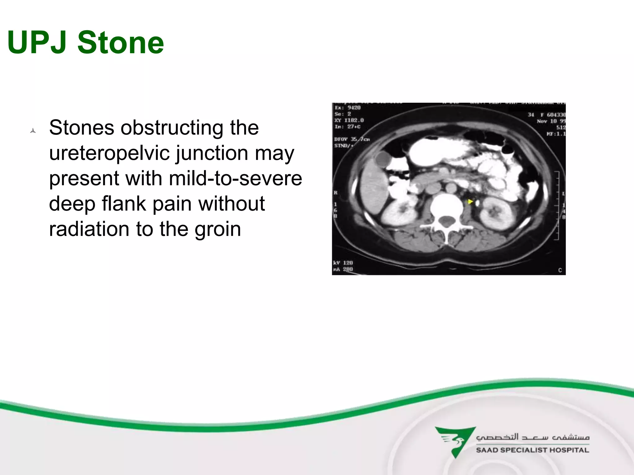Urolithiasis (urinary stones disease) presentation | PPTX