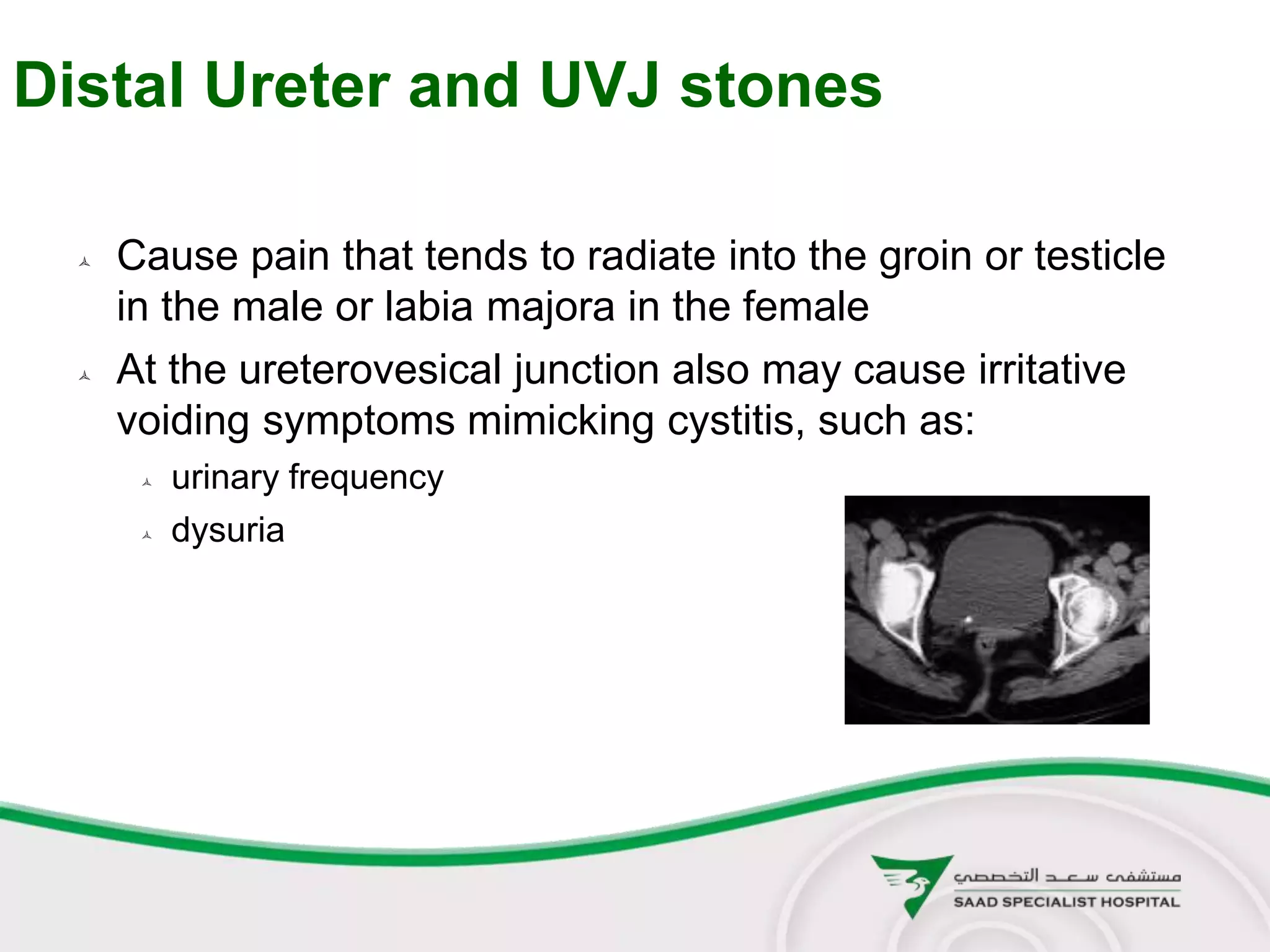 Urolithiasis (urinary stones disease) presentation | PPTX