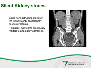Urolithiasis (urinary stones disease) presentation | PPTX