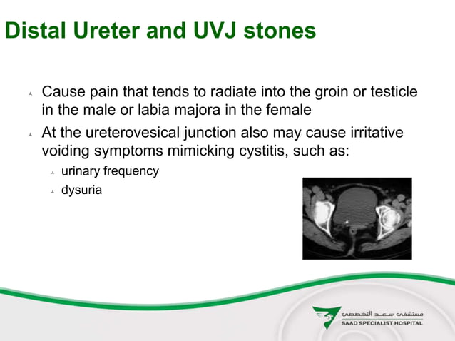 Urolithiasis (urinary stones disease) presentation | PPTX | Digestive ...
