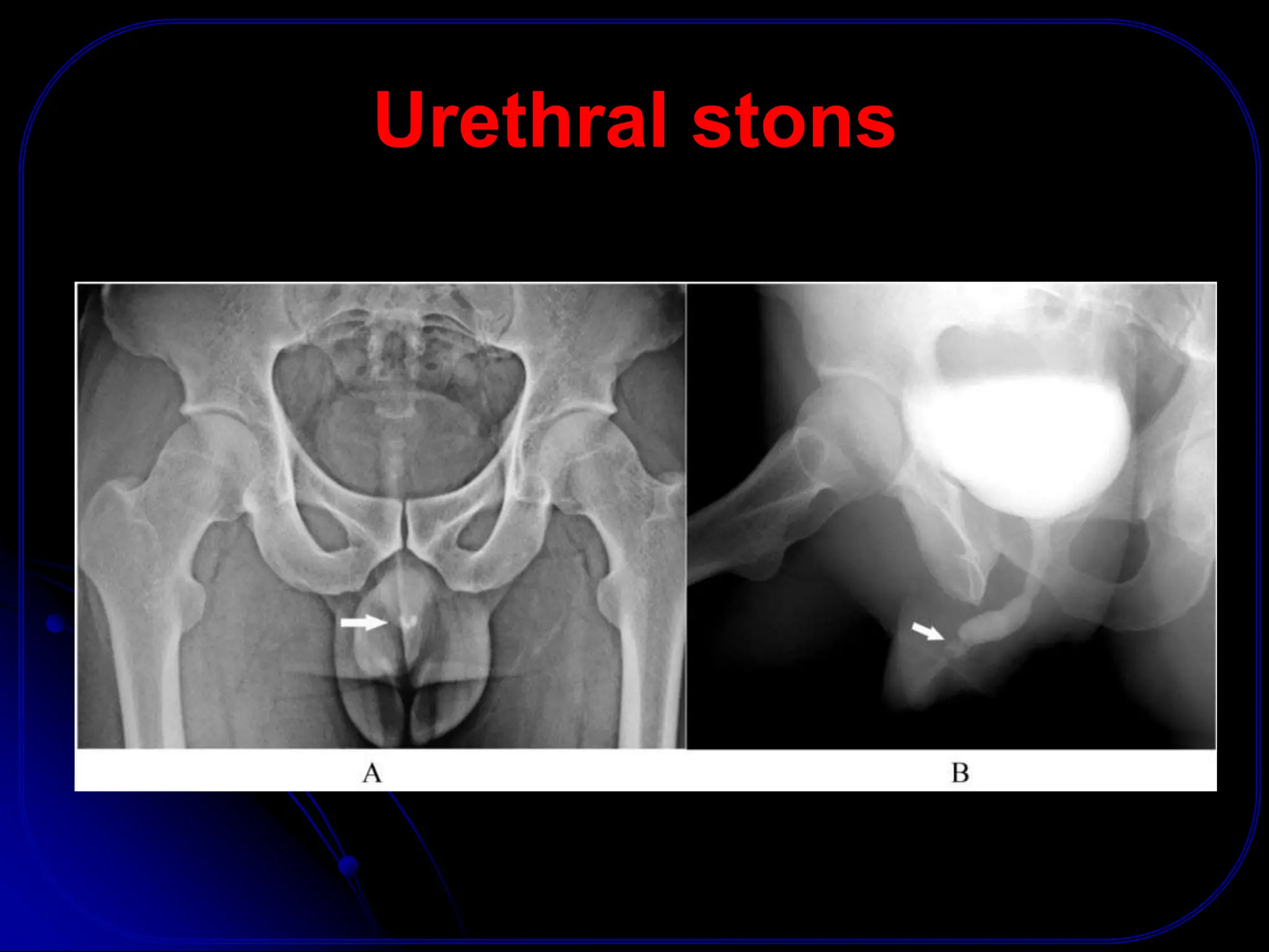 basics of Urological imaging focusig on kub.ppt