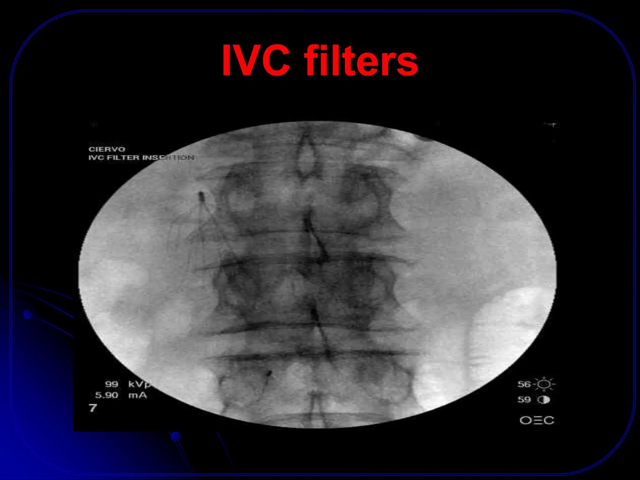 basics of Urological imaging focusig on kub.ppt