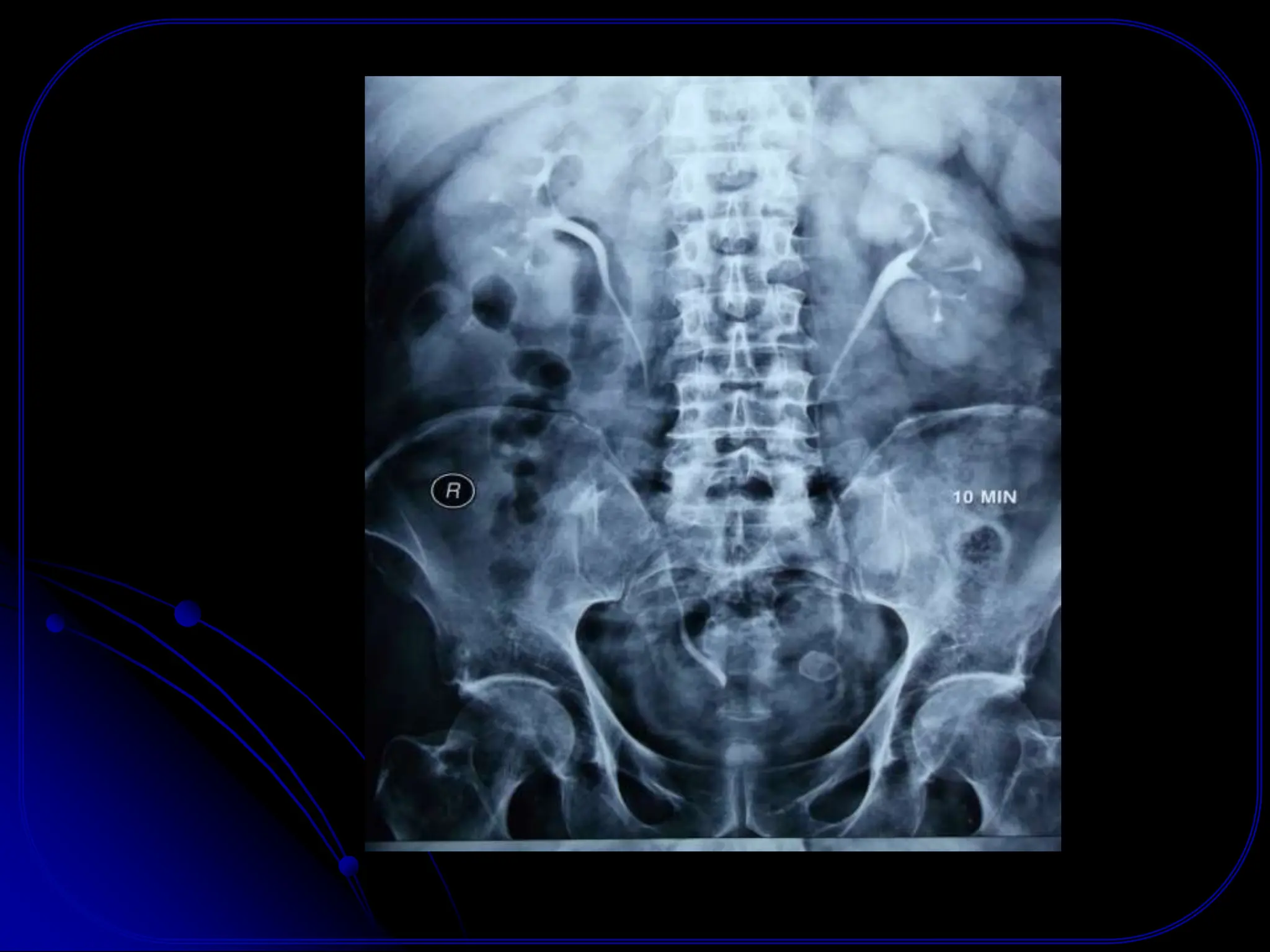 basics of Urological imaging focusig on kub.ppt
