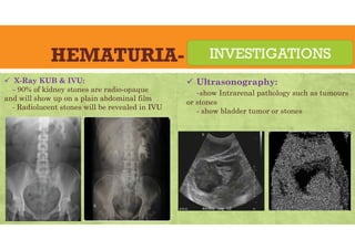 Urology- Hematuria, Renal/Ureteric colic and Bladder Outlet Obstruction ...