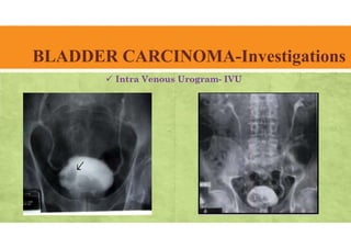 Urology- Hematuria, Renal/Ureteric colic and Bladder Outlet Obstruction ...