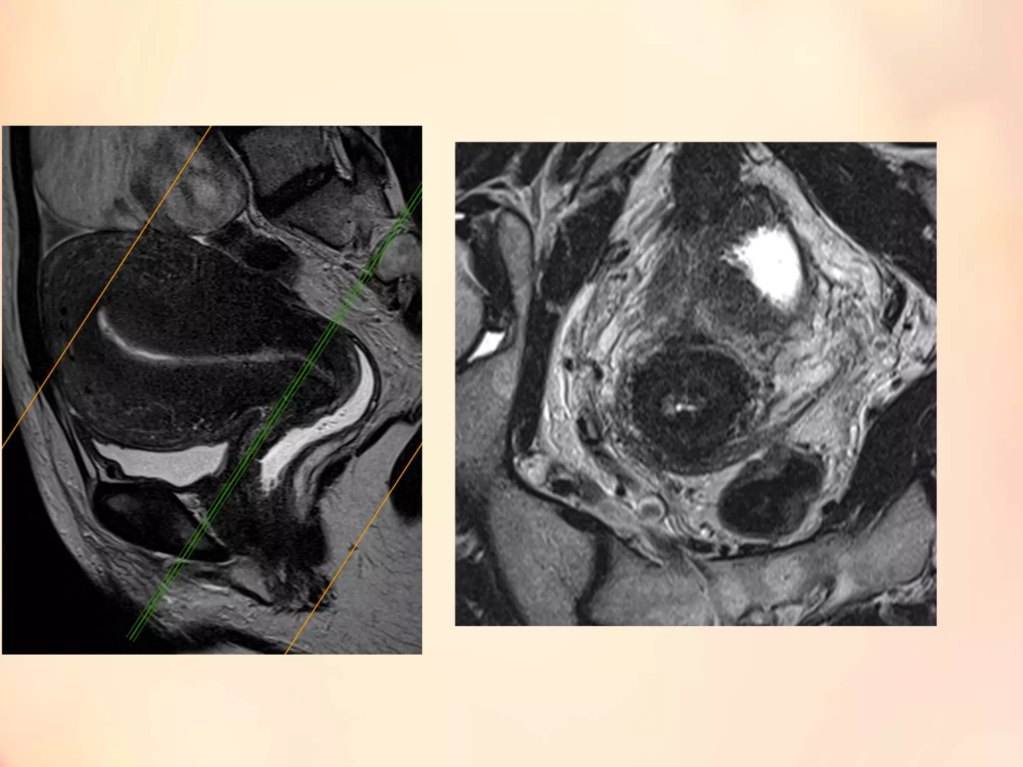 Urology gynecology mri staging for ca cervix | PDF