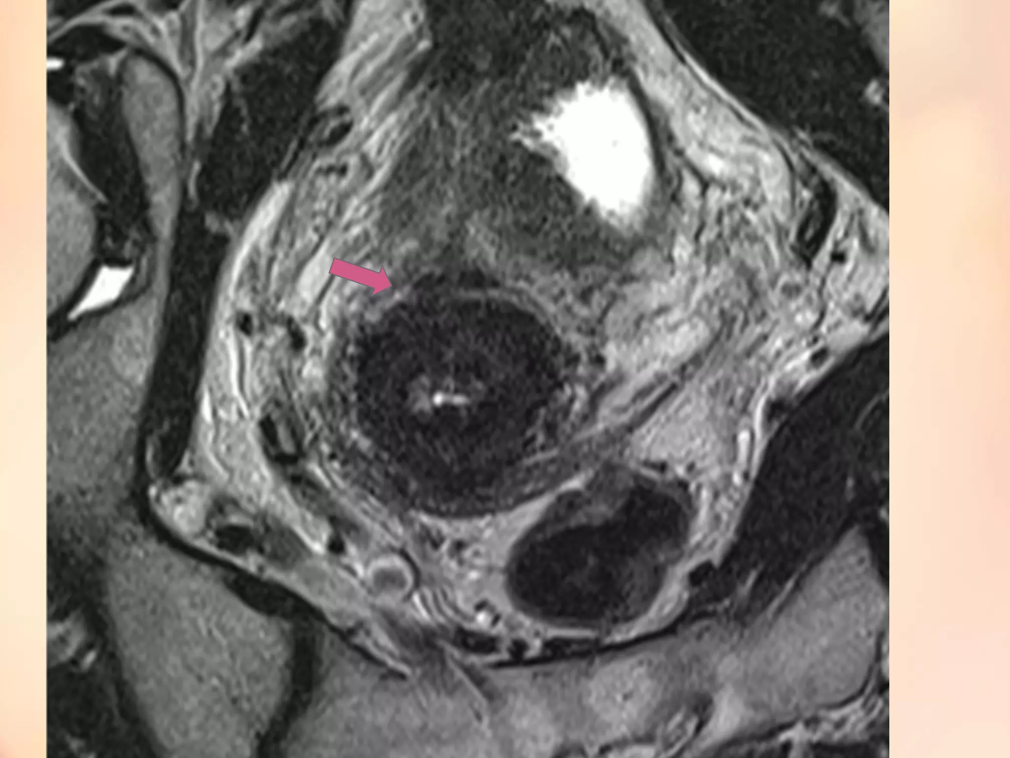 Urology gynecology mri staging for ca cervix | PDF