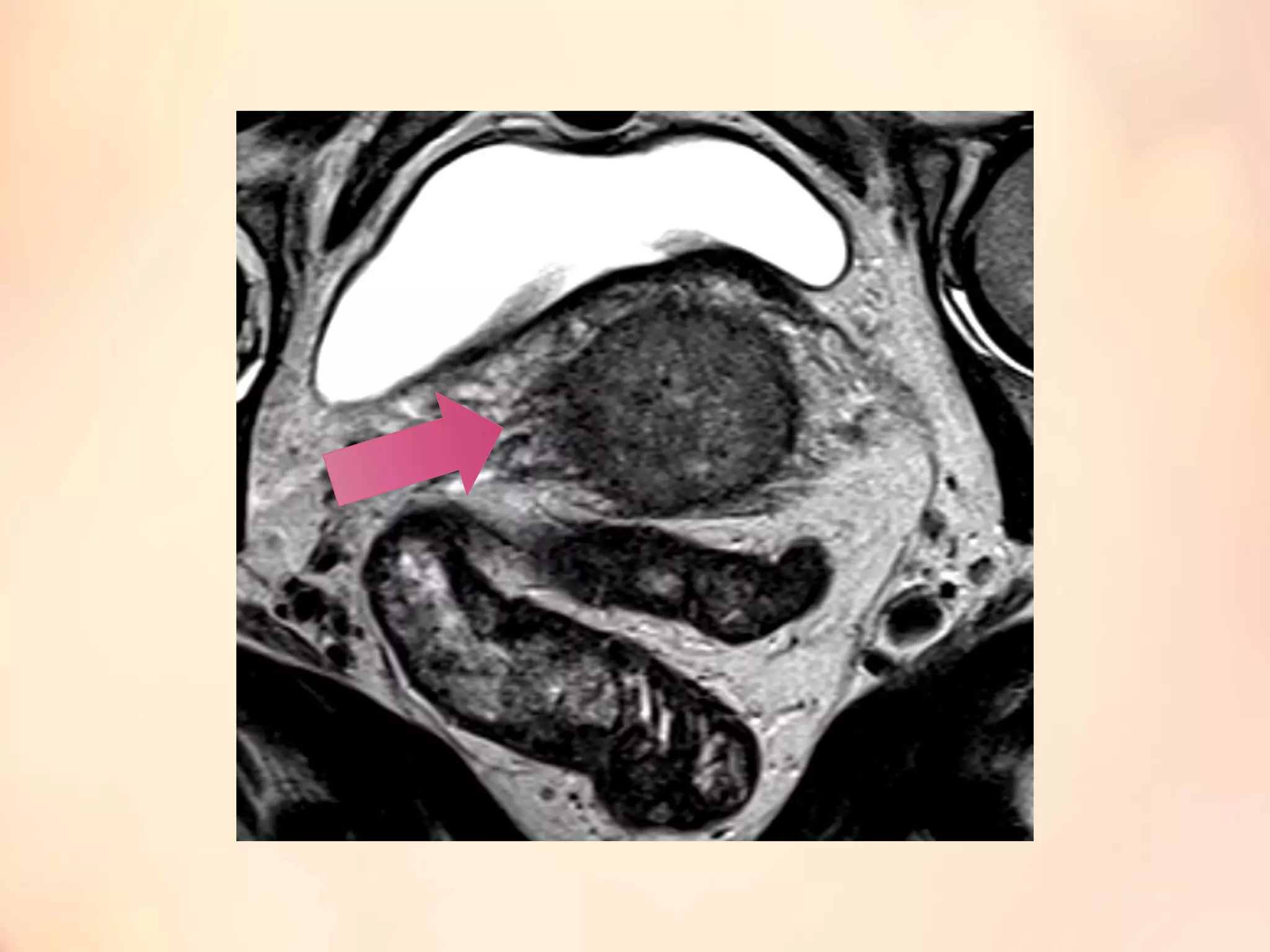 Urology gynecology mri staging for ca cervix | PDF