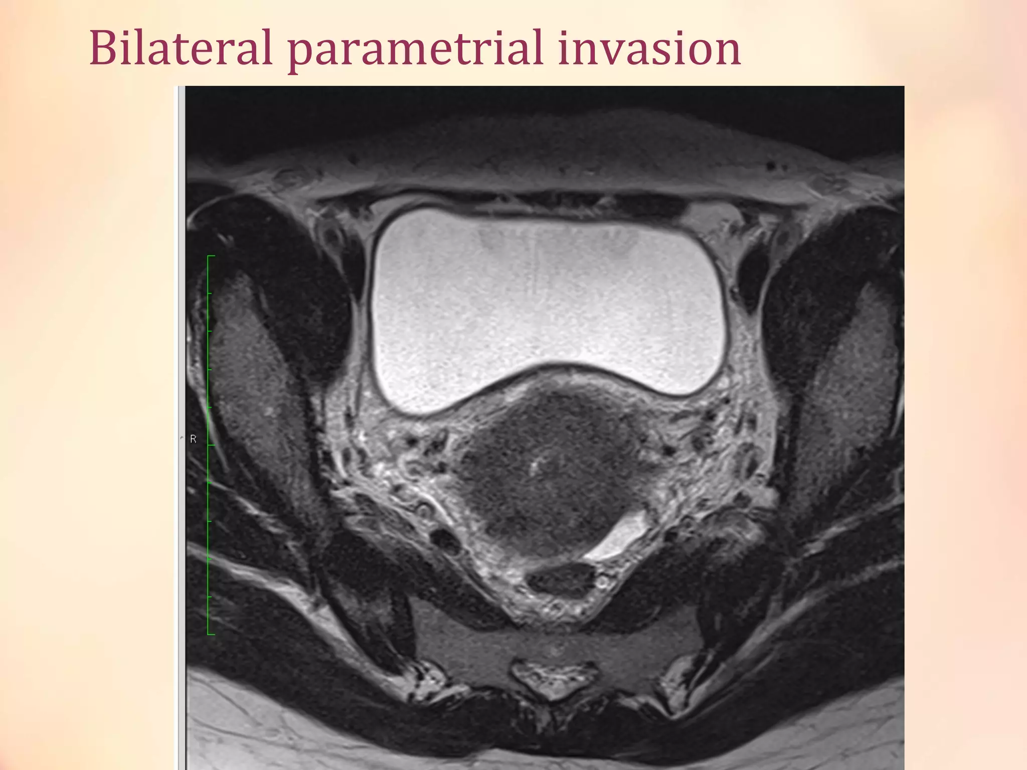 Urology gynecology mri staging for ca cervix | PDF