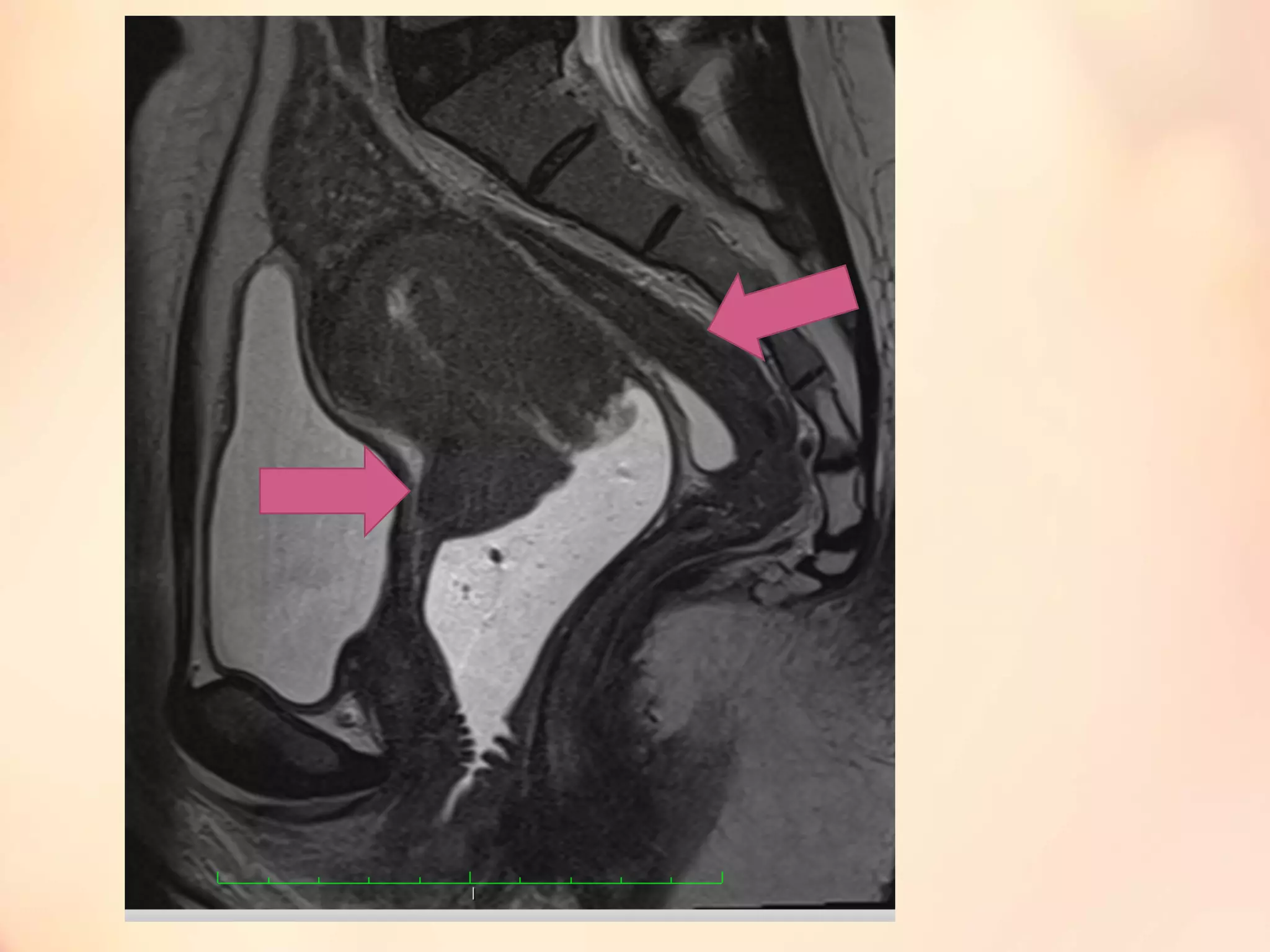 Urology gynecology mri staging for ca cervix | PDF
