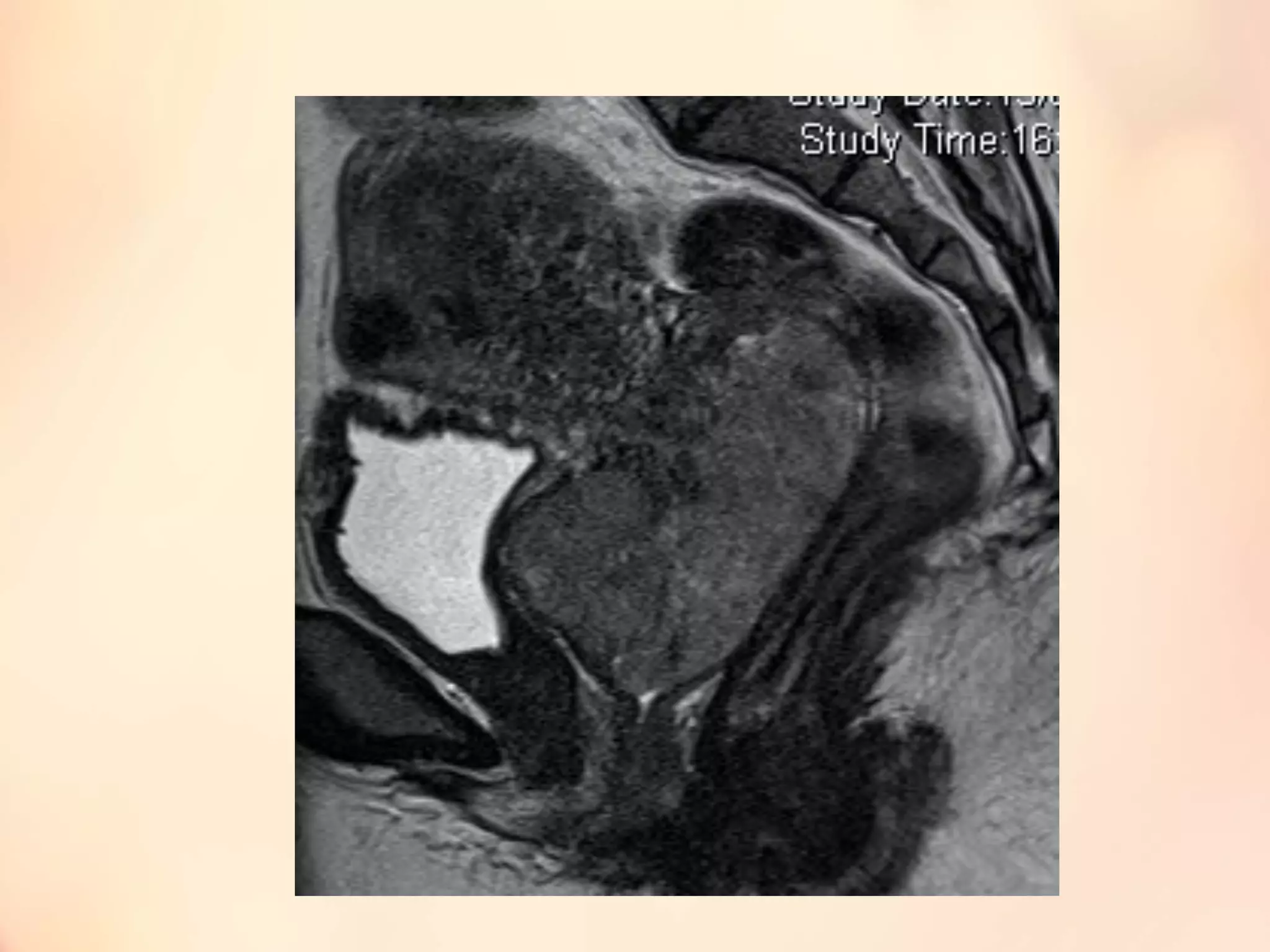 Urology gynecology mri staging for ca cervix | PDF