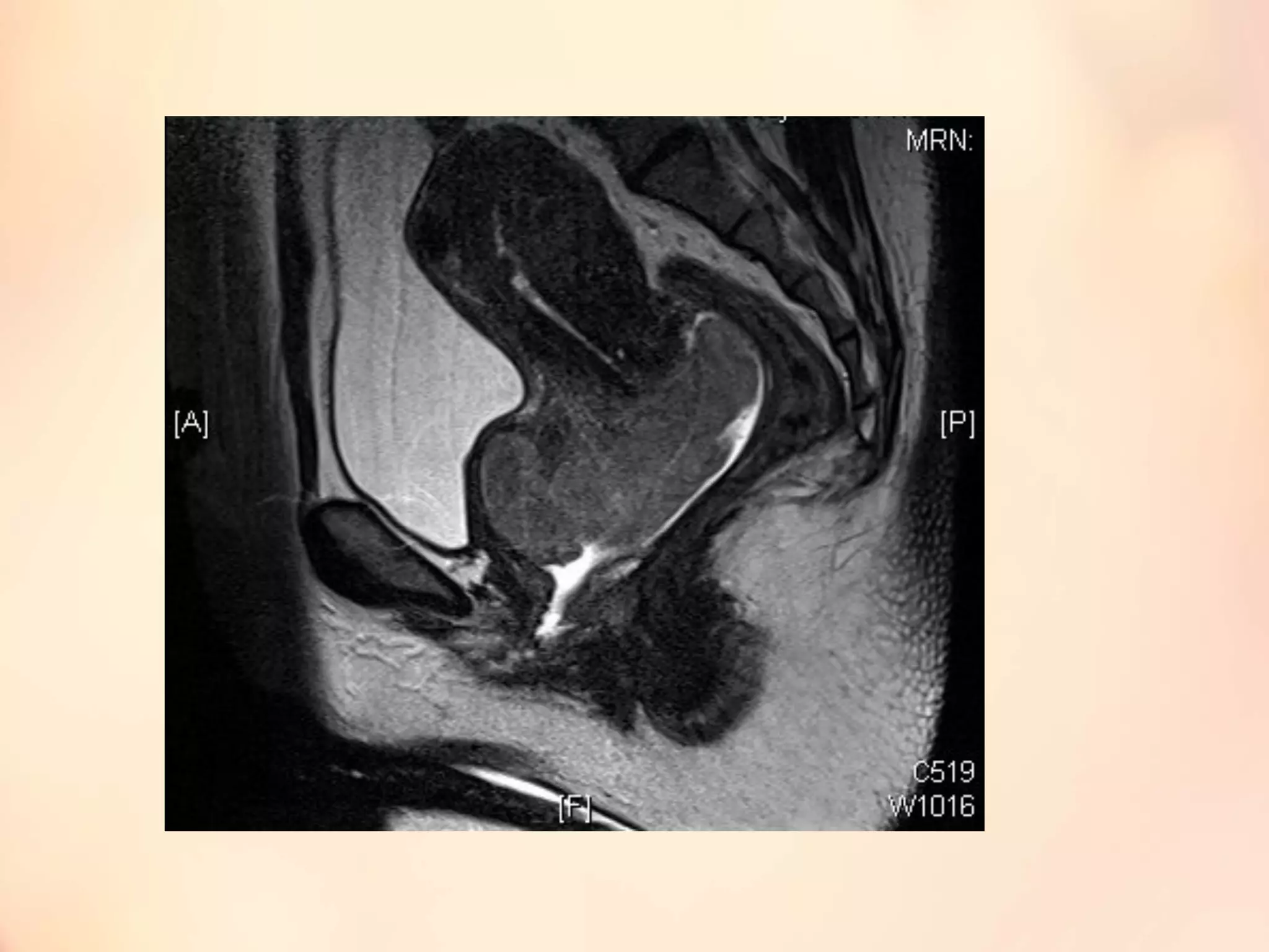 Urology gynecology mri staging for ca cervix | PDF
