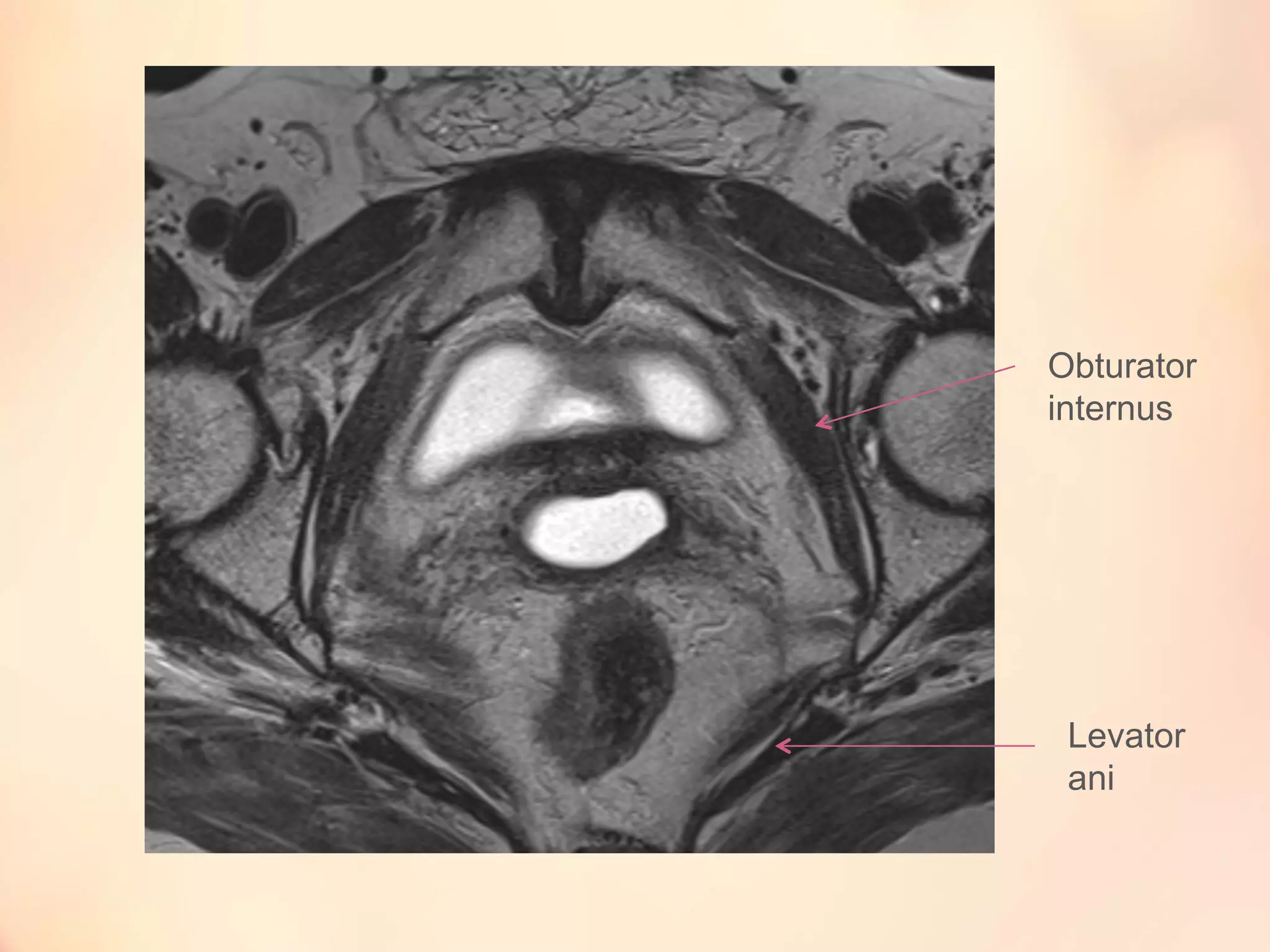 Urology gynecology mri staging for ca cervix | PDF
