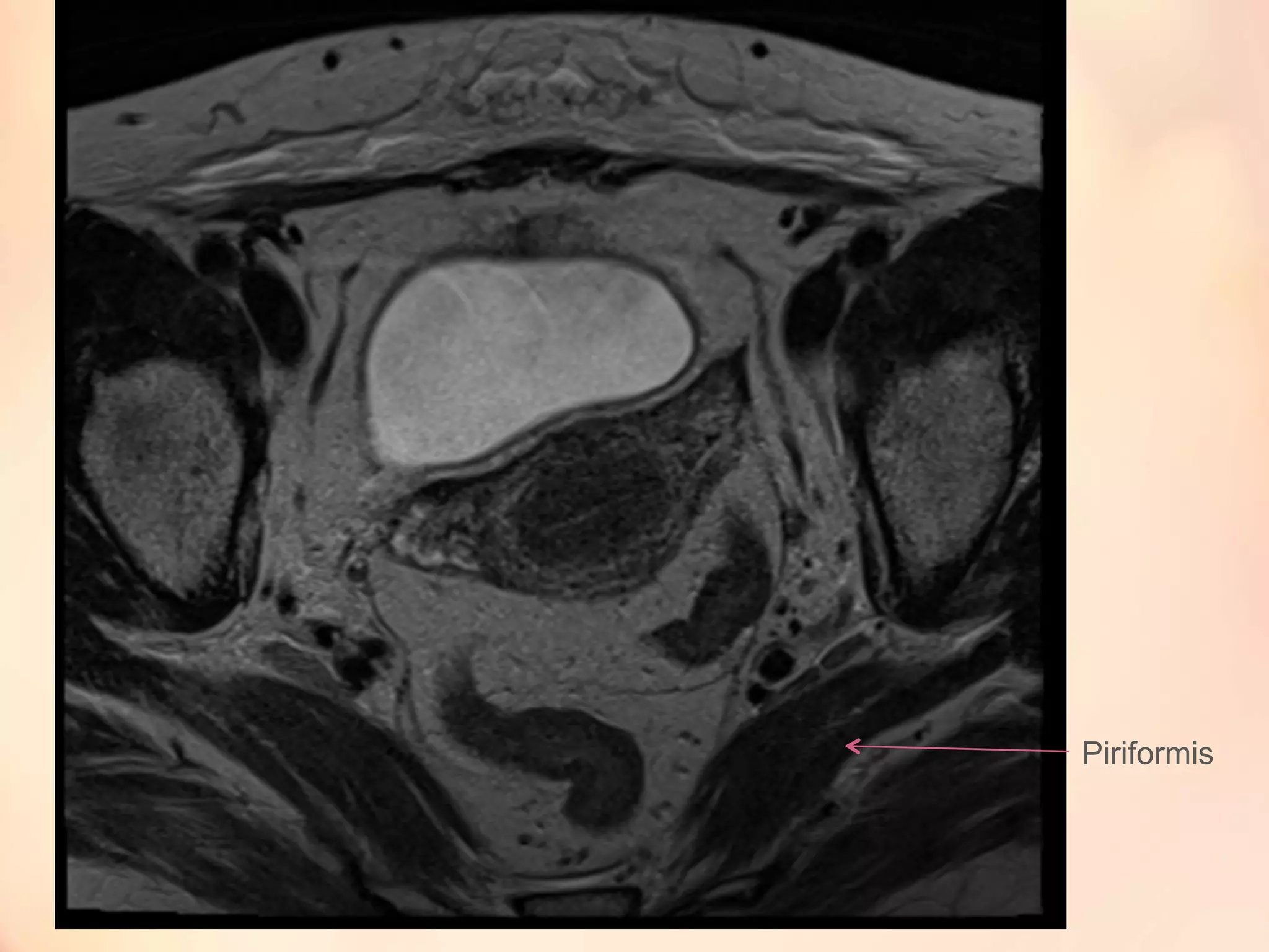 Urology gynecology mri staging for ca cervix | PDF
