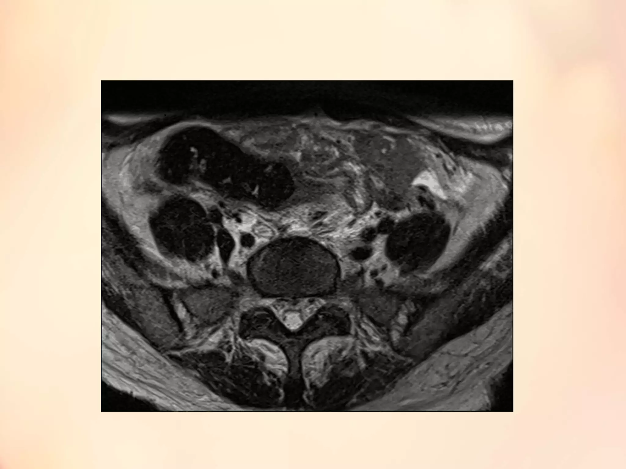 Urology gynecology mri staging for ca cervix | PDF