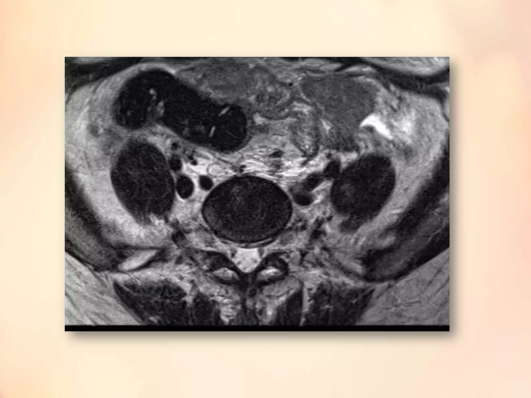 Urology gynecology mri staging for ca cervix | PDF