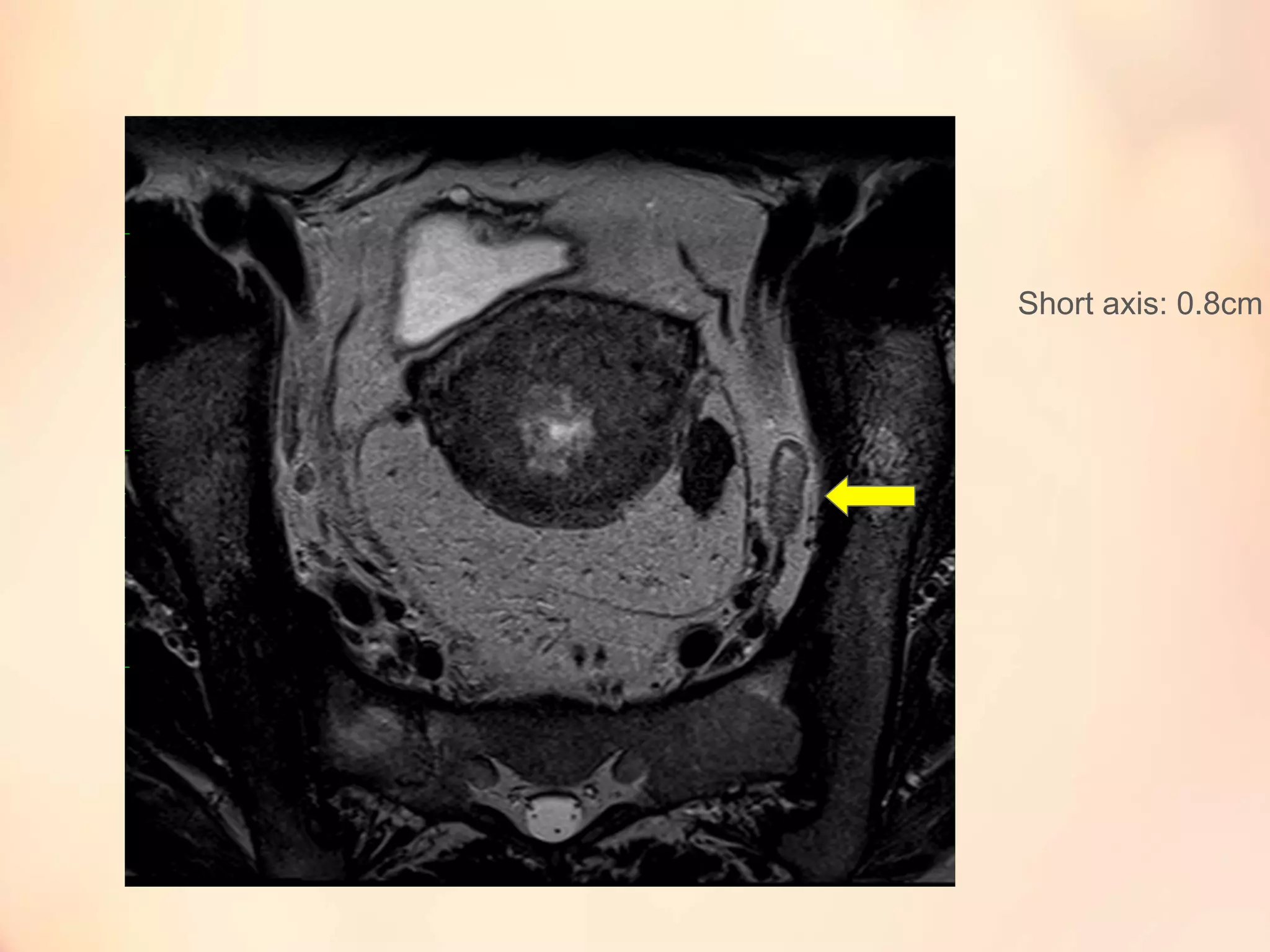 Urology gynecology mri staging for ca cervix | PDF
