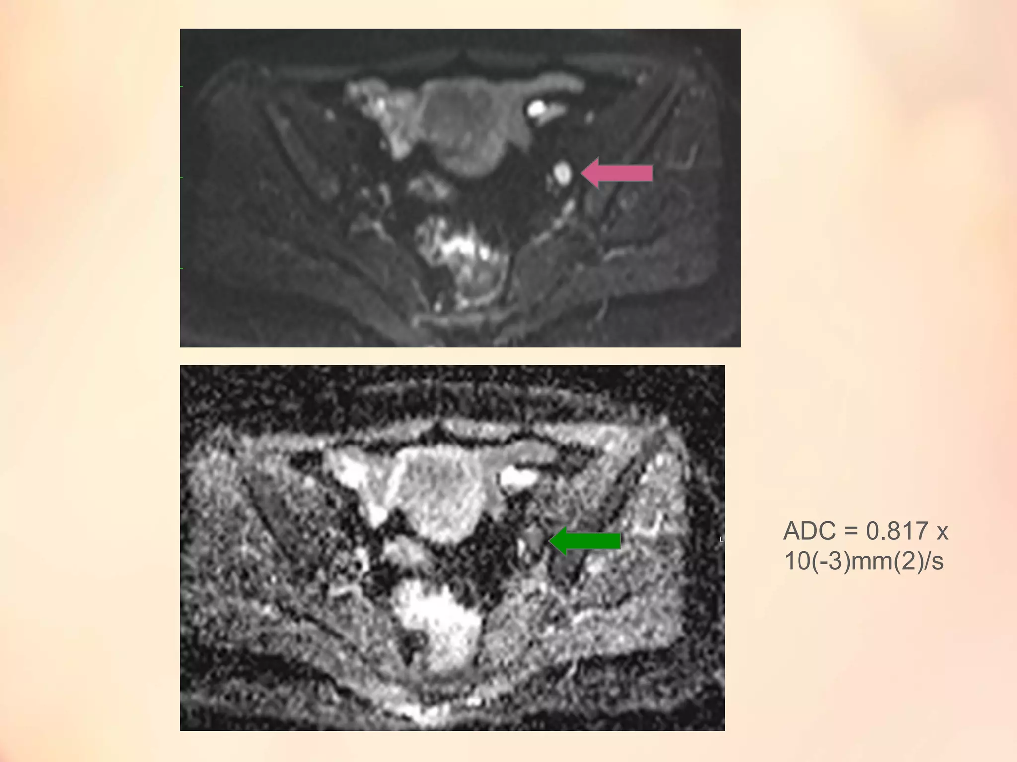 Urology gynecology mri staging for ca cervix | PDF