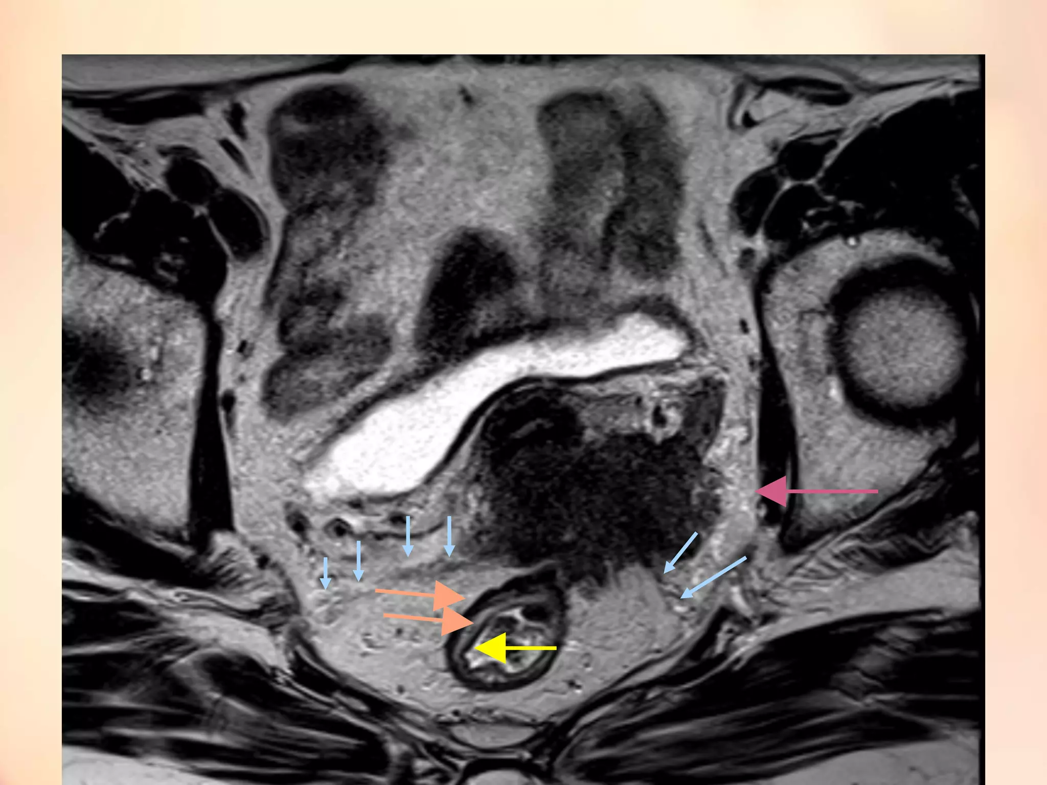 Urology gynecology mri staging for ca cervix | PDF