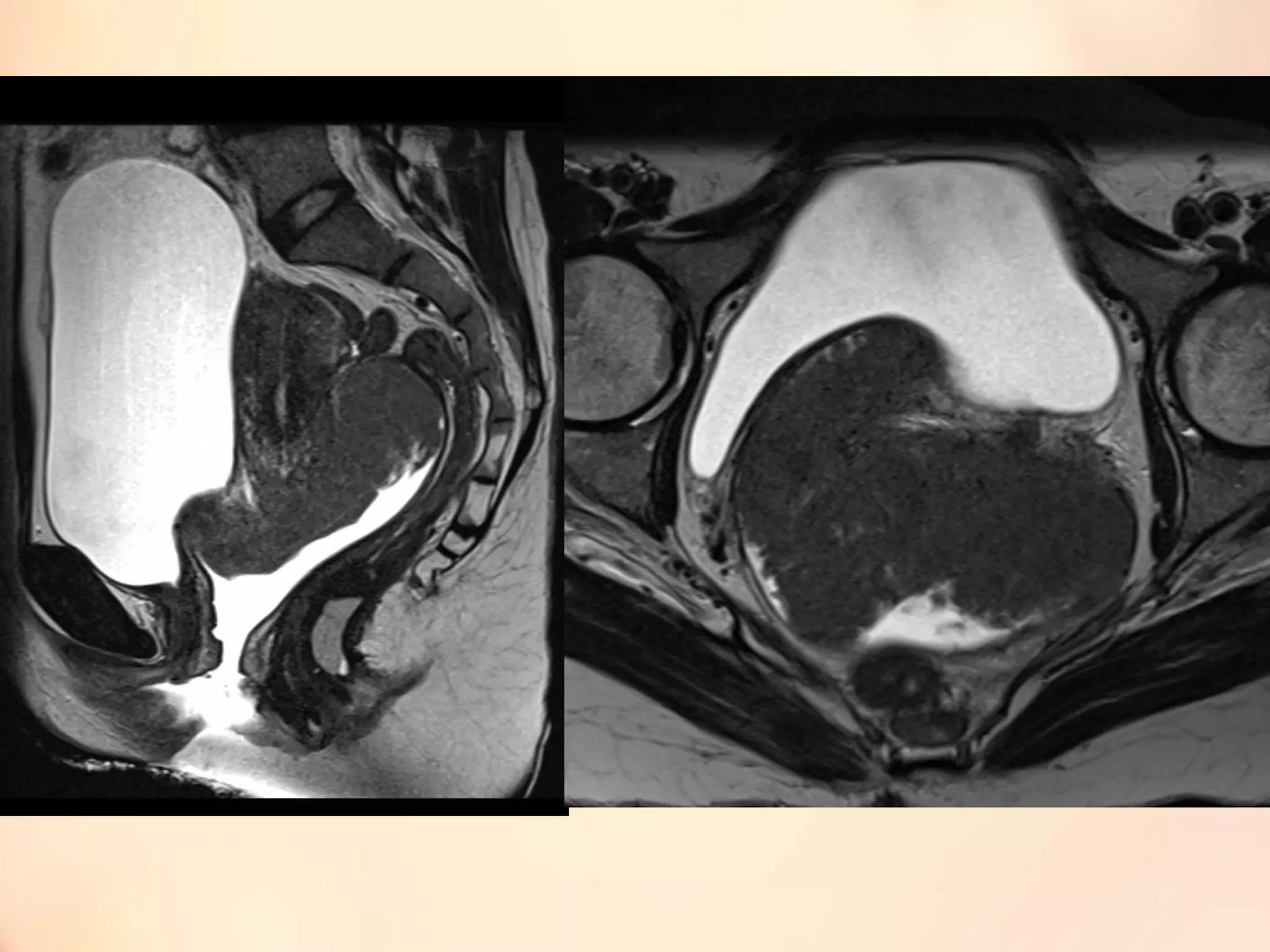 Urology gynecology mri staging for ca cervix | PDF