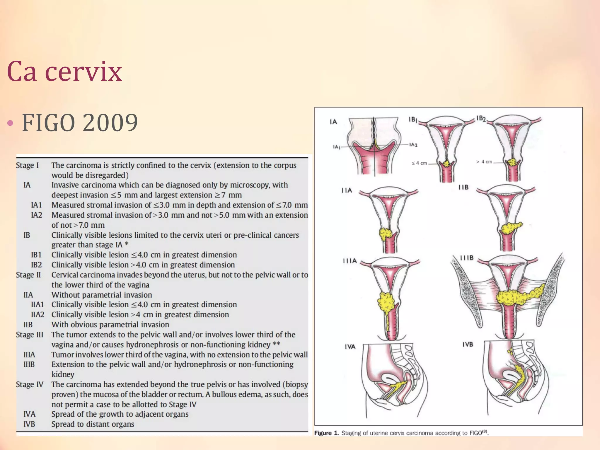 Urology gynecology mri staging for ca cervix | PDF