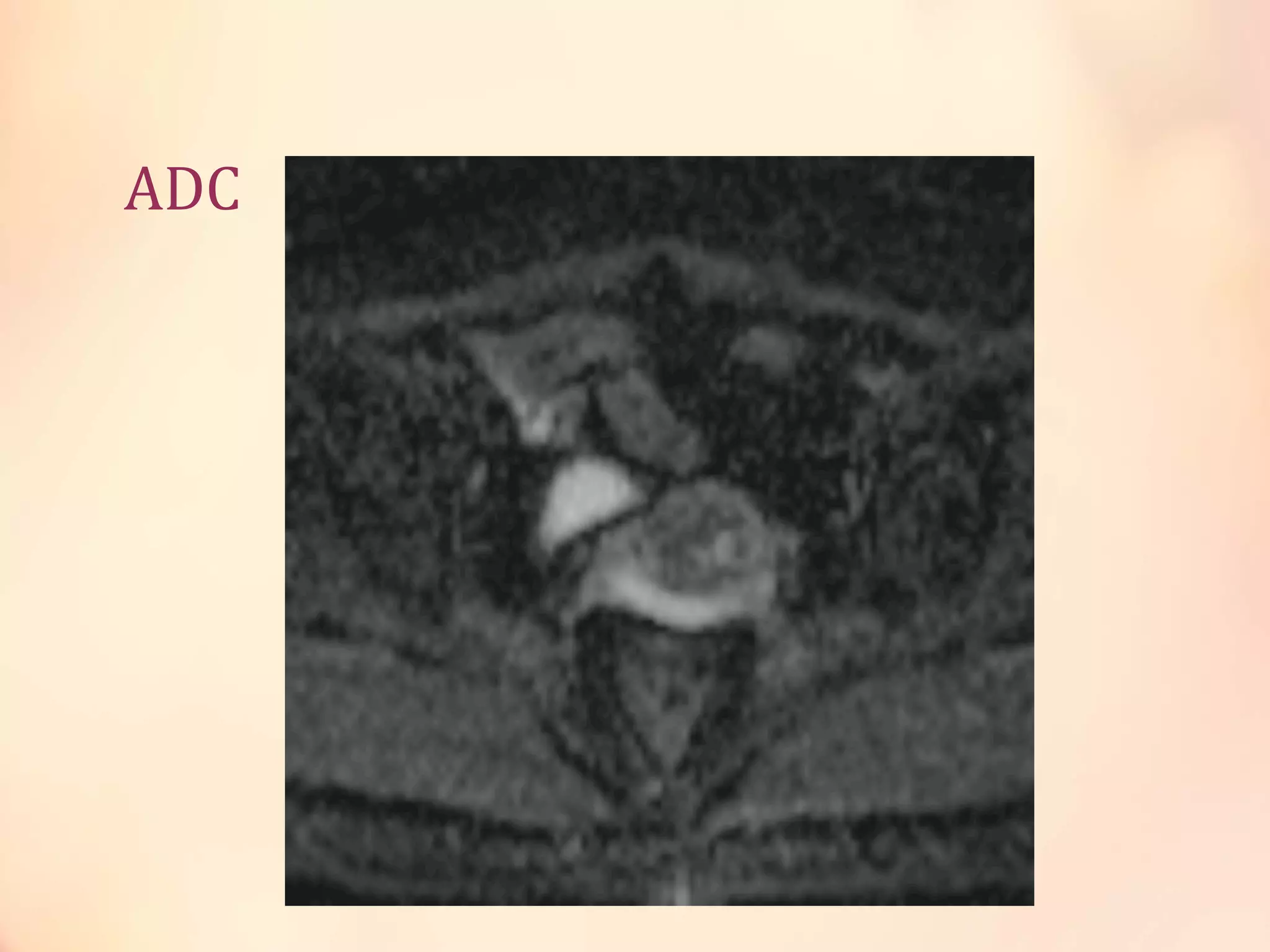 Urology gynecology mri staging for ca cervix | PDF