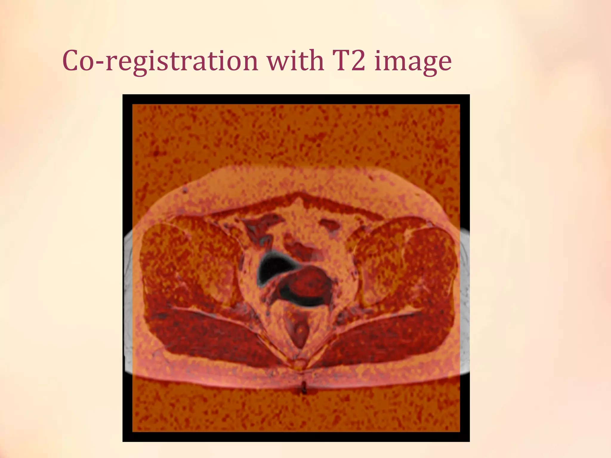 Urology gynecology mri staging for ca cervix | PDF