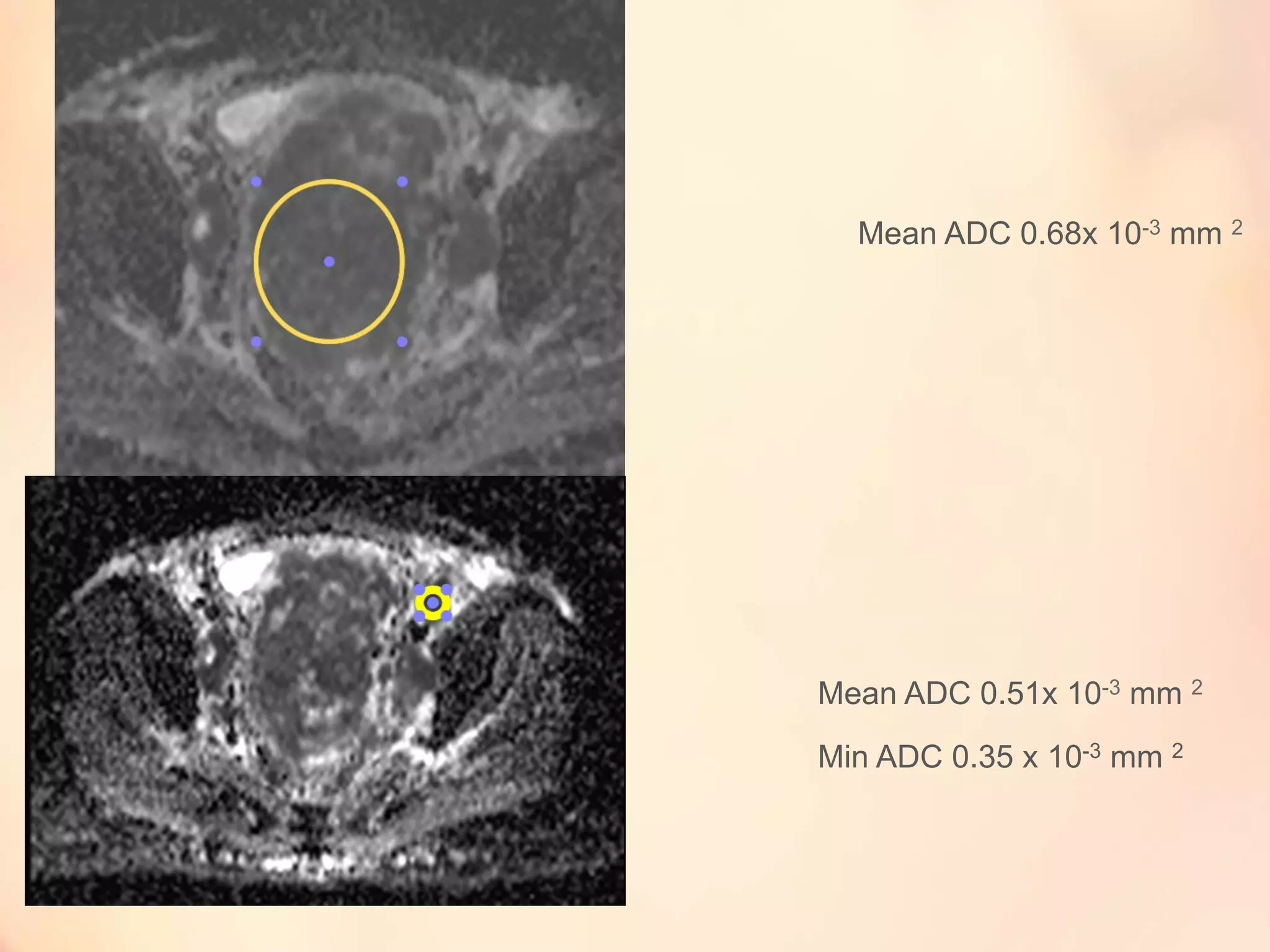 Urology gynecology mri staging for ca cervix | PDF