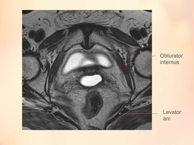 Urology gynecology mri staging for ca cervix | PPT | Free Download