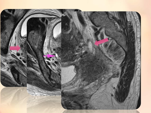 Urology gynecology mri staging for ca cervix | PDF