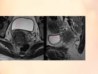 Urology gynecology mri staging for ca cervix | PDF