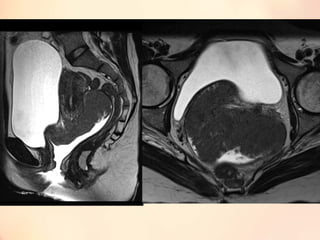 Urology gynecology mri staging for ca cervix | PDF
