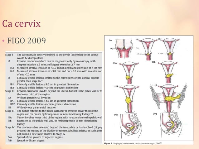 Urology gynecology mri staging for ca cervix | PDF