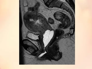 Urology gynecology mri staging for ca cervix | PDF