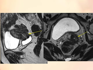 Urology gynecology mri staging for ca cervix | PDF