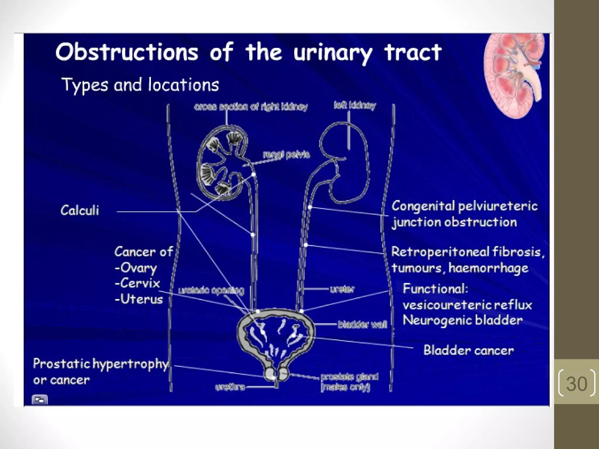 Urology 4 hydronephrosis | PPT