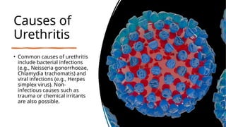 Understanding Urethritis Urology Medicine | PPT