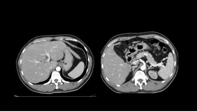 Case Presentation: Urothelial Cancer of the Renal Pelvis