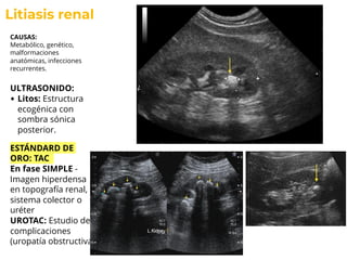 LITIASIS RENAL | PPT