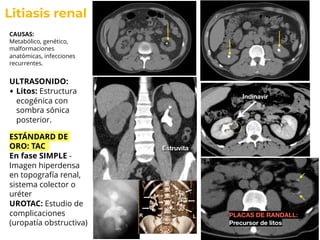 LITIASIS RENAL | PPT