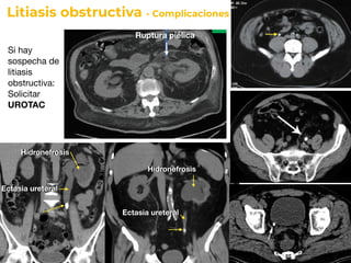 LITIASIS RENAL | PPT