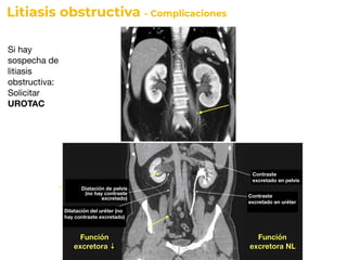 LITIASIS RENAL | PPT